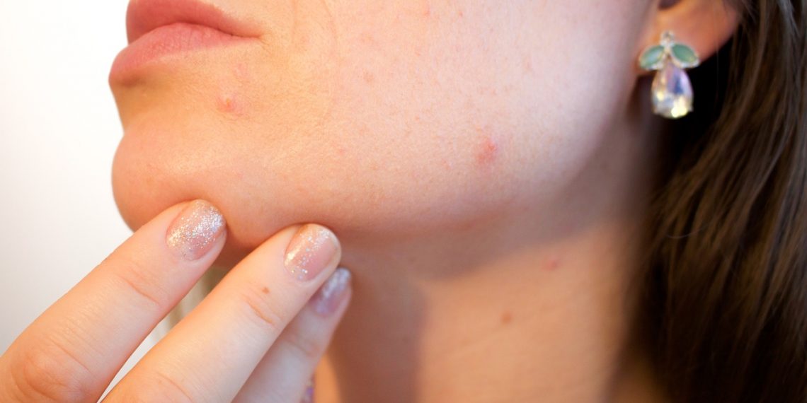 6 Tips on How to Clear up Acne | E-Dirt